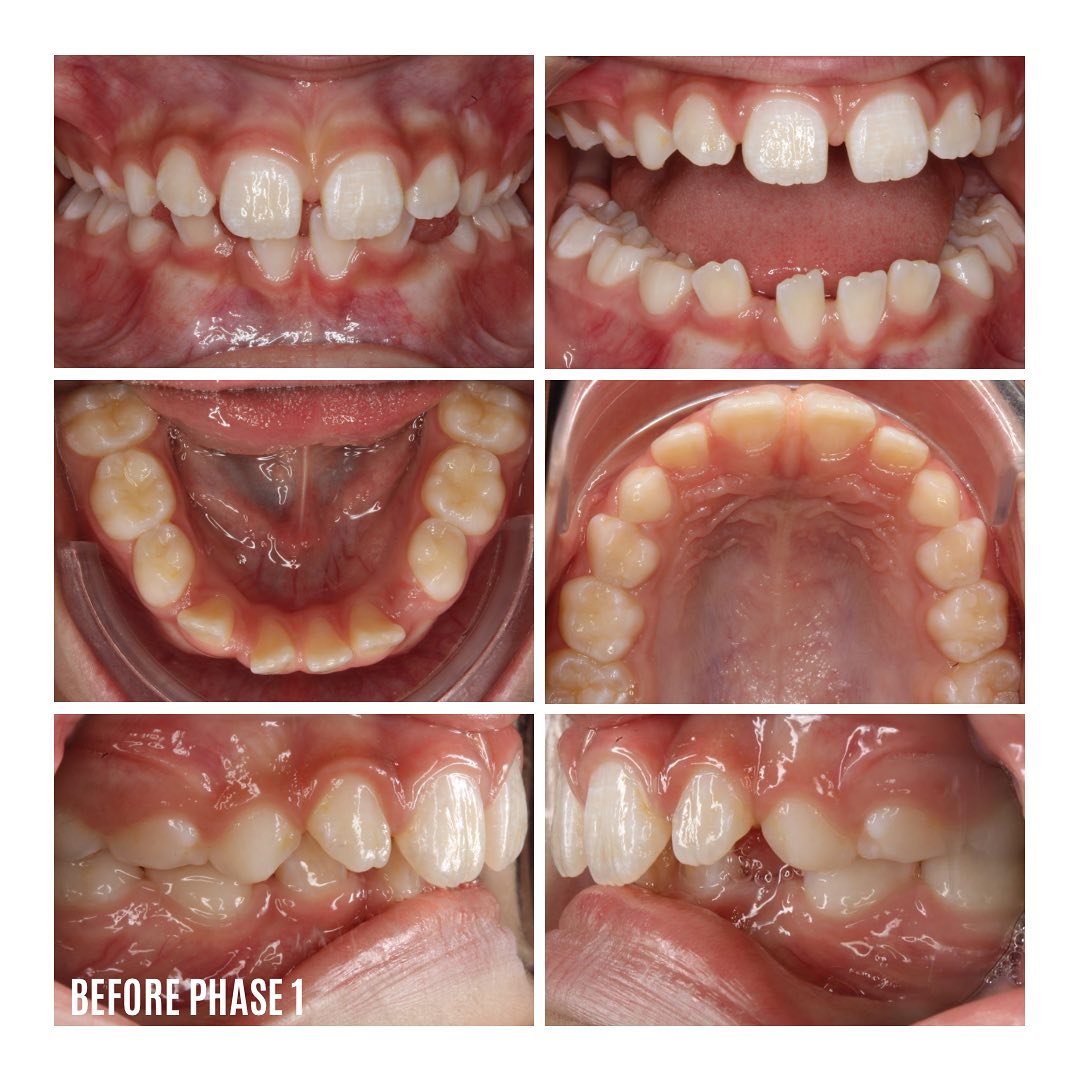 Phase 1 Braces in Johnson City: Early Orthodontics Guide